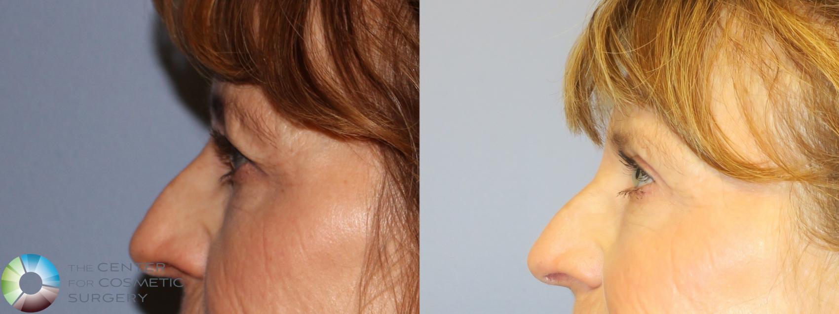 Eyelid Lift Before and After Pictures Case 11368 | Denver and Colorado ...