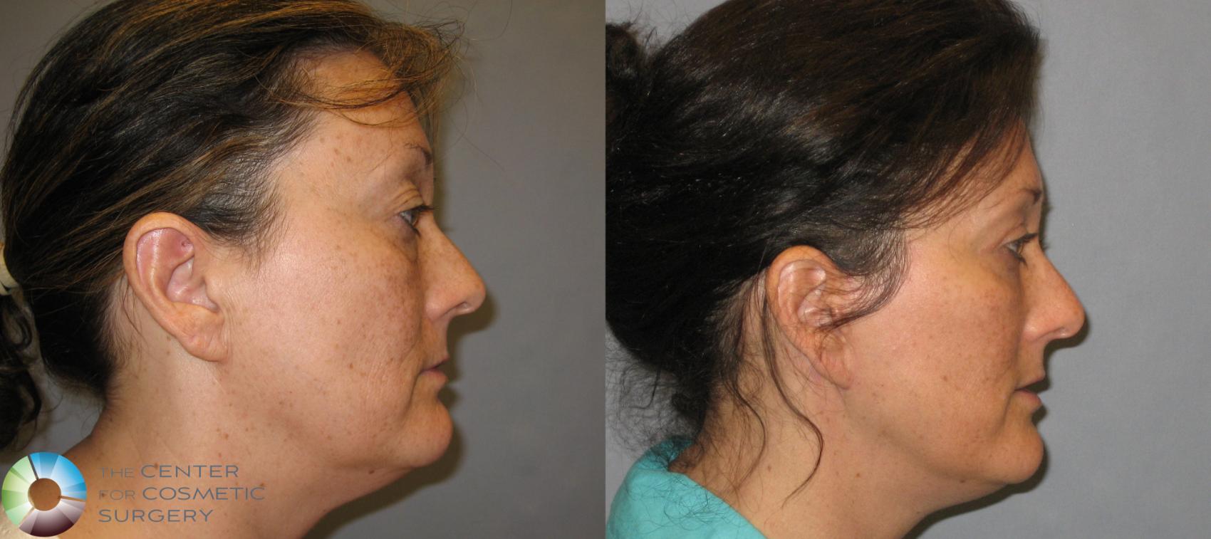 Eyelid Lift Before and After Pictures Case 161 | Denver and Colorado ...