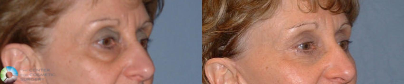 Eyelid Lift Before and After Pictures Case 56 | Denver and Colorado ...